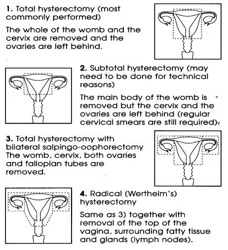Hysterectomy Milton Keynes University Hospital